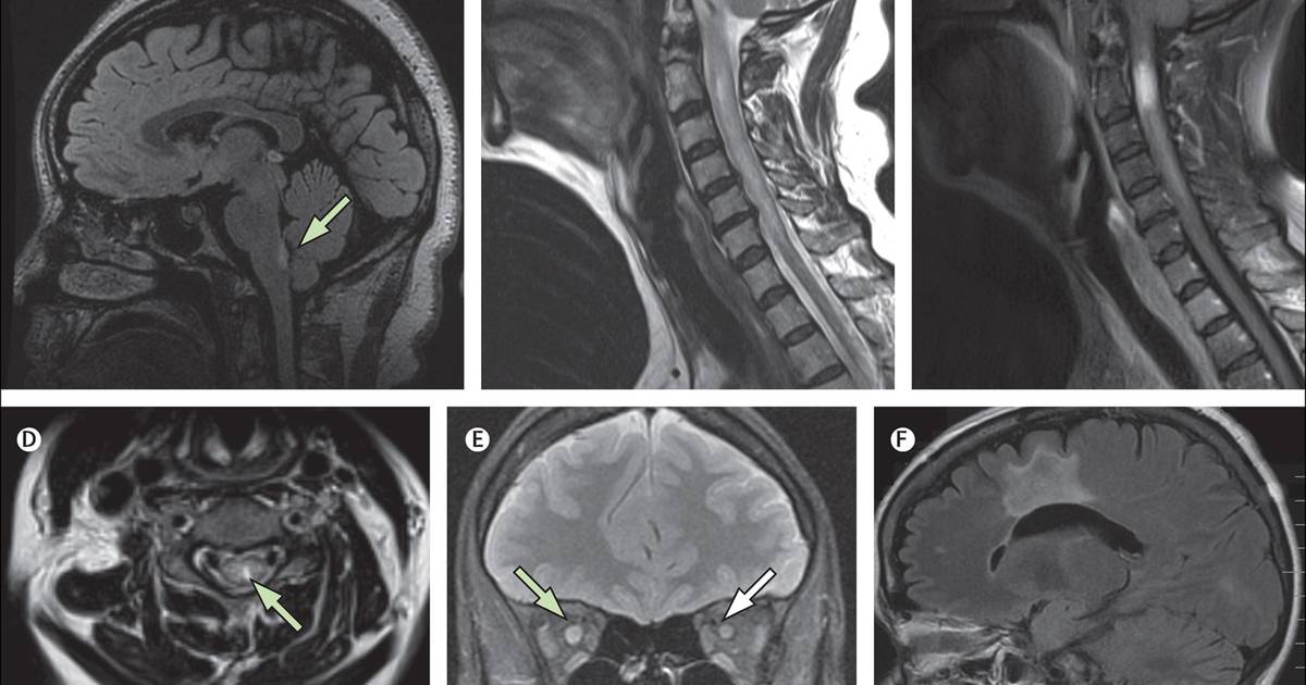 Neuromyelitis Optica (NMO) - symptomer, årsager og behandlinger ...